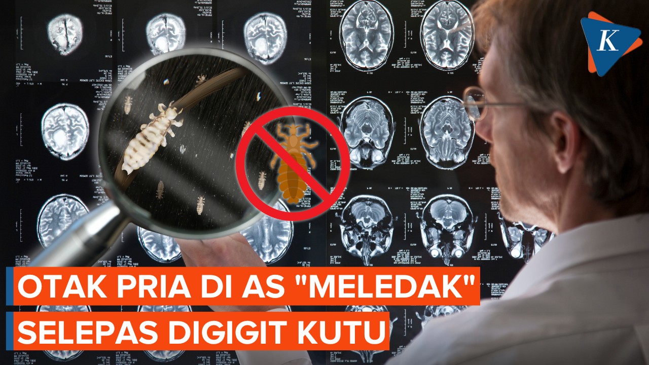 Video: Pria di AS Meninggal Setelah Otaknya "Meledak" Selepas Digigit Kutu