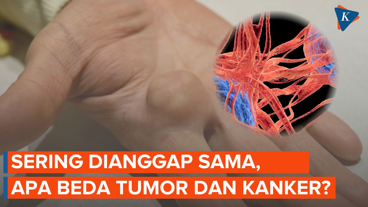 Sering Dianggap Sama, Ini Beda Tumor dan Kanker